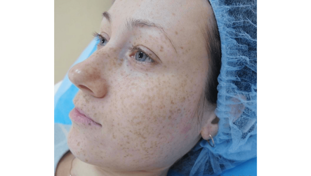 Hyper Pigmentation Treatment | Elrevo Clinic