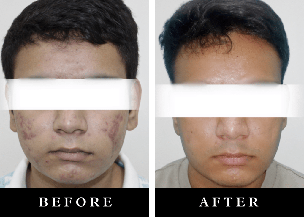 High Density Hair Transplant Elrevo Clinic High Density Hair Transplant Elrevo Clinic