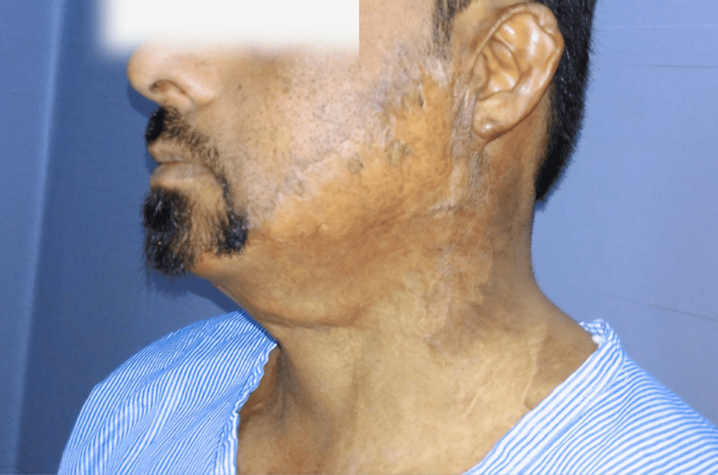 Burn hair transplant | Elrevo Clinic