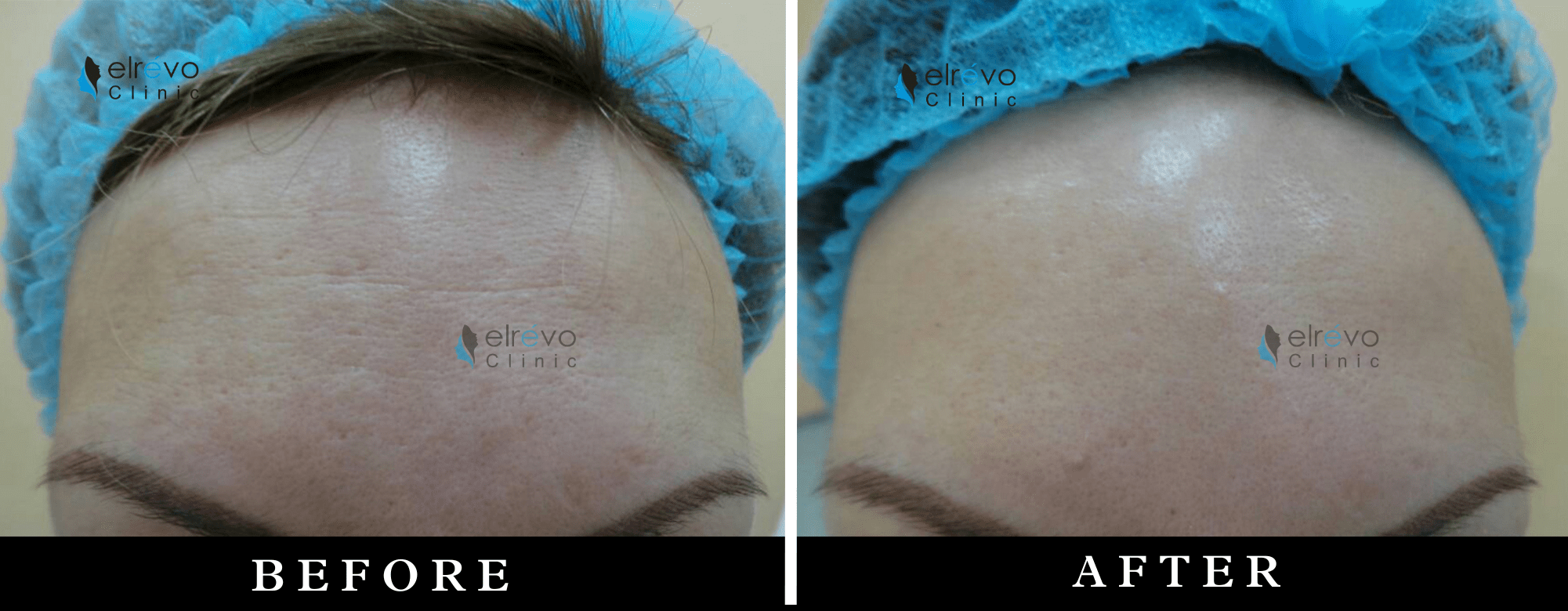 Skin Rejuvenation Aging | Elrevo Clinic
